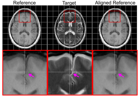 Multi-Modal MRI Reconstruction Assisted with Spatial Alignment Network ...